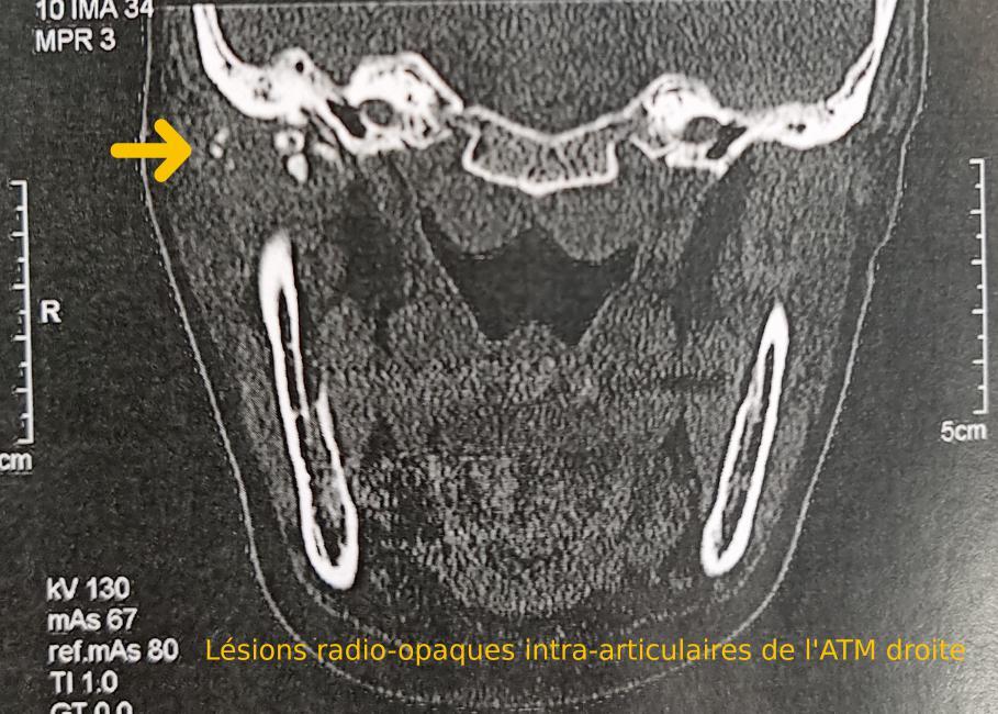 La chondromatose synoviale de l’articulation temporo-mandibulaire