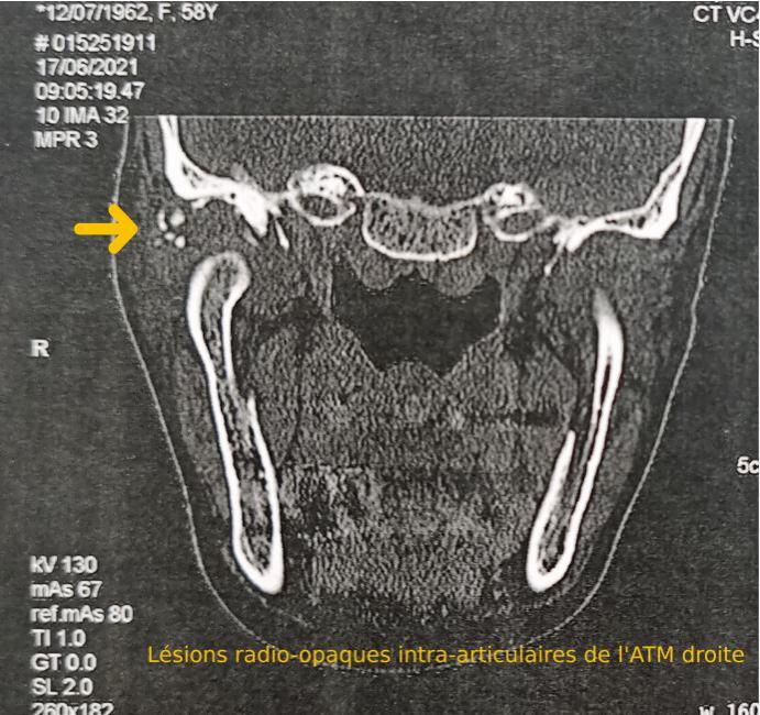 La chondromatose synoviale de l’articulation temporo-mandibulaire